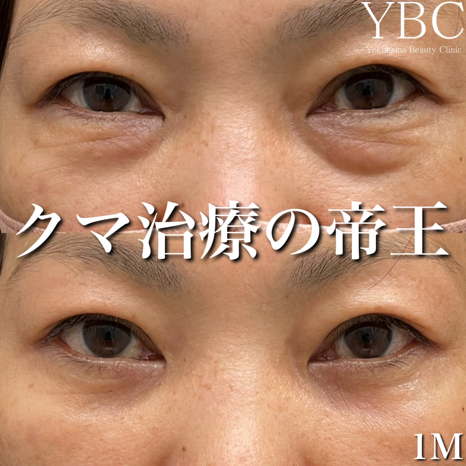 切らない目の下のたるみとり 1M | YBC横浜美容外科