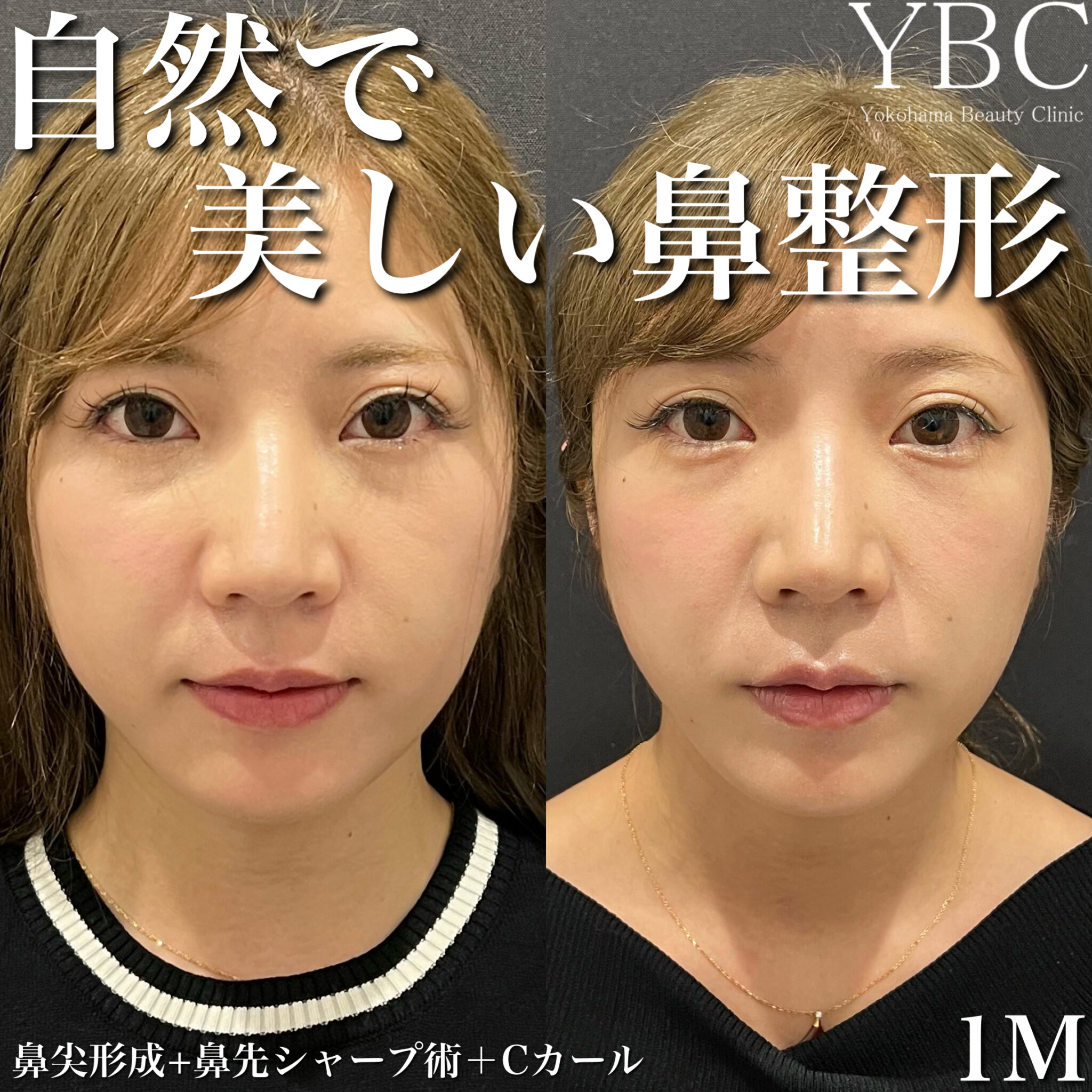 YBC式鼻先シャープ術・鼻尖形成・Cカール形成 1M | YBC横浜美容外科