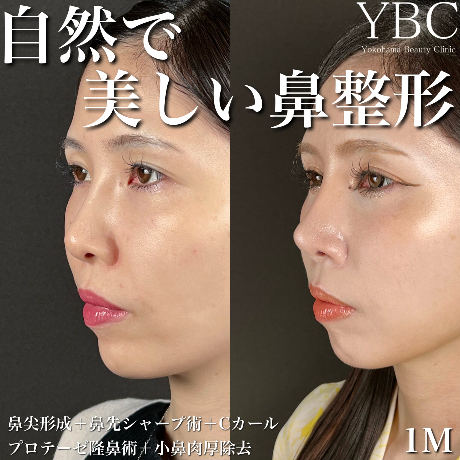 【鼻整形】YBC式鼻先シャープ術・鼻尖形成・Cカール形成・プロテーゼ隆鼻術・小鼻肉厚除去 1M | YBC横浜美容外科