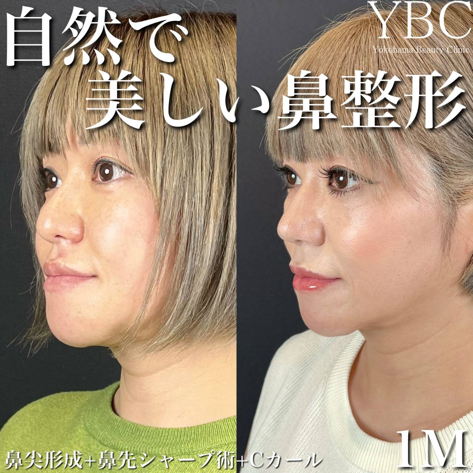 【鼻整形】YBC式鼻尖形成・鼻先シャープ術・Cカール形成 1M | YBC横浜美容外科